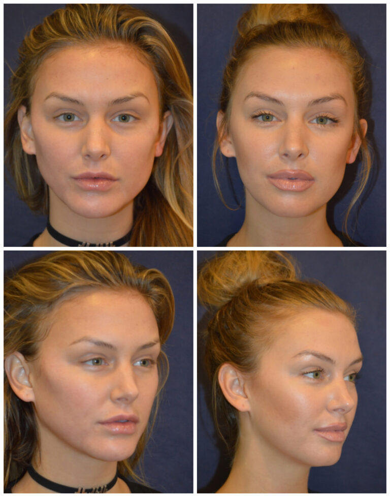 Vanderpump Rules' Lala Kent Tells All On Recent Cosmetic Procedures