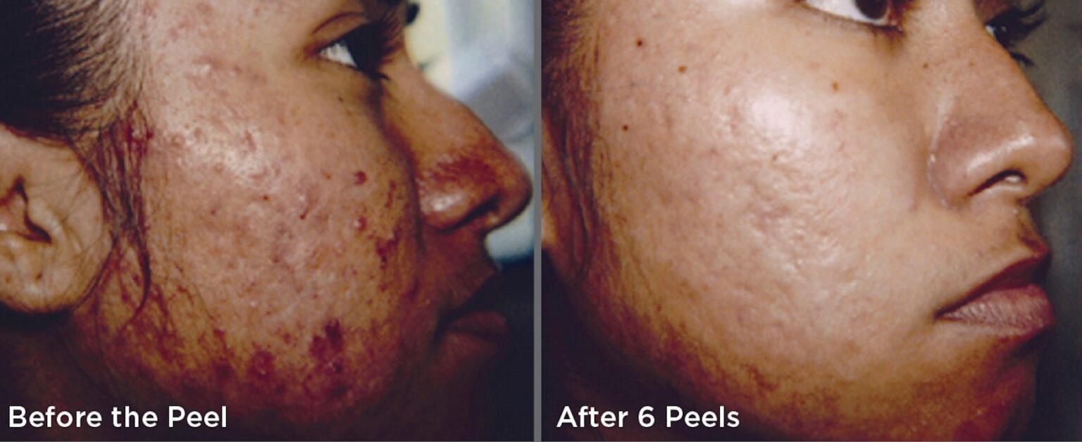 Types of Chemical Peels: Before & After, Side Effects, Cost, and Aftercare