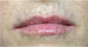 Volbella: Cost, Before & After, Side Effects and Aftercare