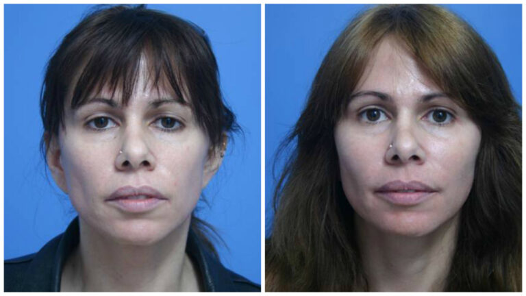 Over-the-Counter vs. Professional Chemical Peels - Zwivel