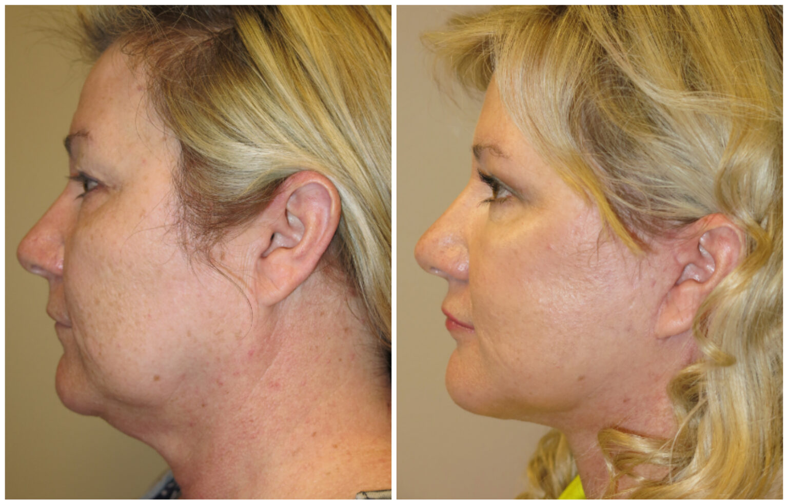 Beat the Wattle: Turkey Neck Surgery and Minimally-Invasive Alternatives
