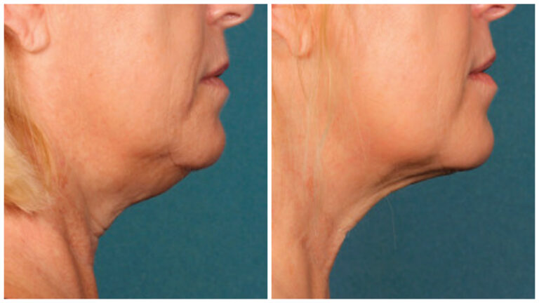 Beat the Wattle: Turkey Neck Surgery and Minimally-Invasive Alternatives