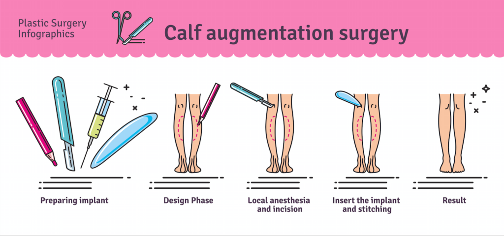 Calf Implants (Augmentation): Cost, Before and After, Risks, and Recovery