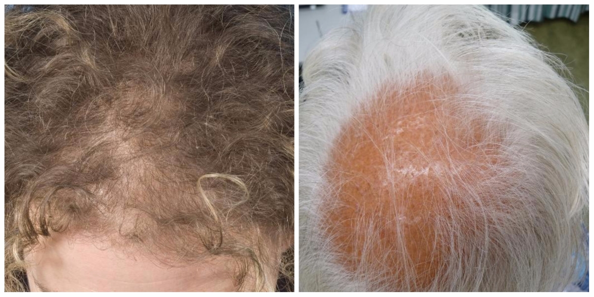 Female Hair Loss: Why It Happens and What You Can Do About It