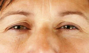 Canthal Tilt Surgery: Preventing Premature Dropping of the Canthi