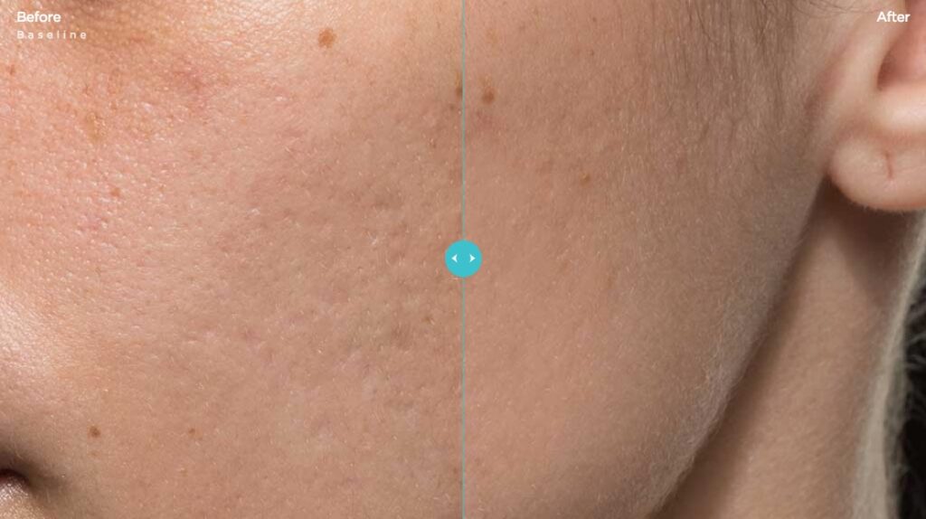 Bellafill (Artefill): Review, Before and After, Complications and Cost