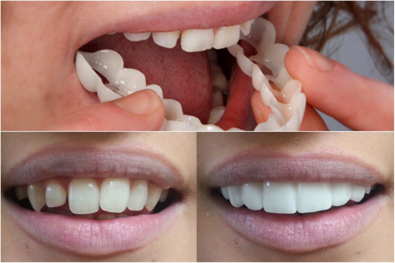 Snap-On Smile: Review, Before and After, Pros, and Cost