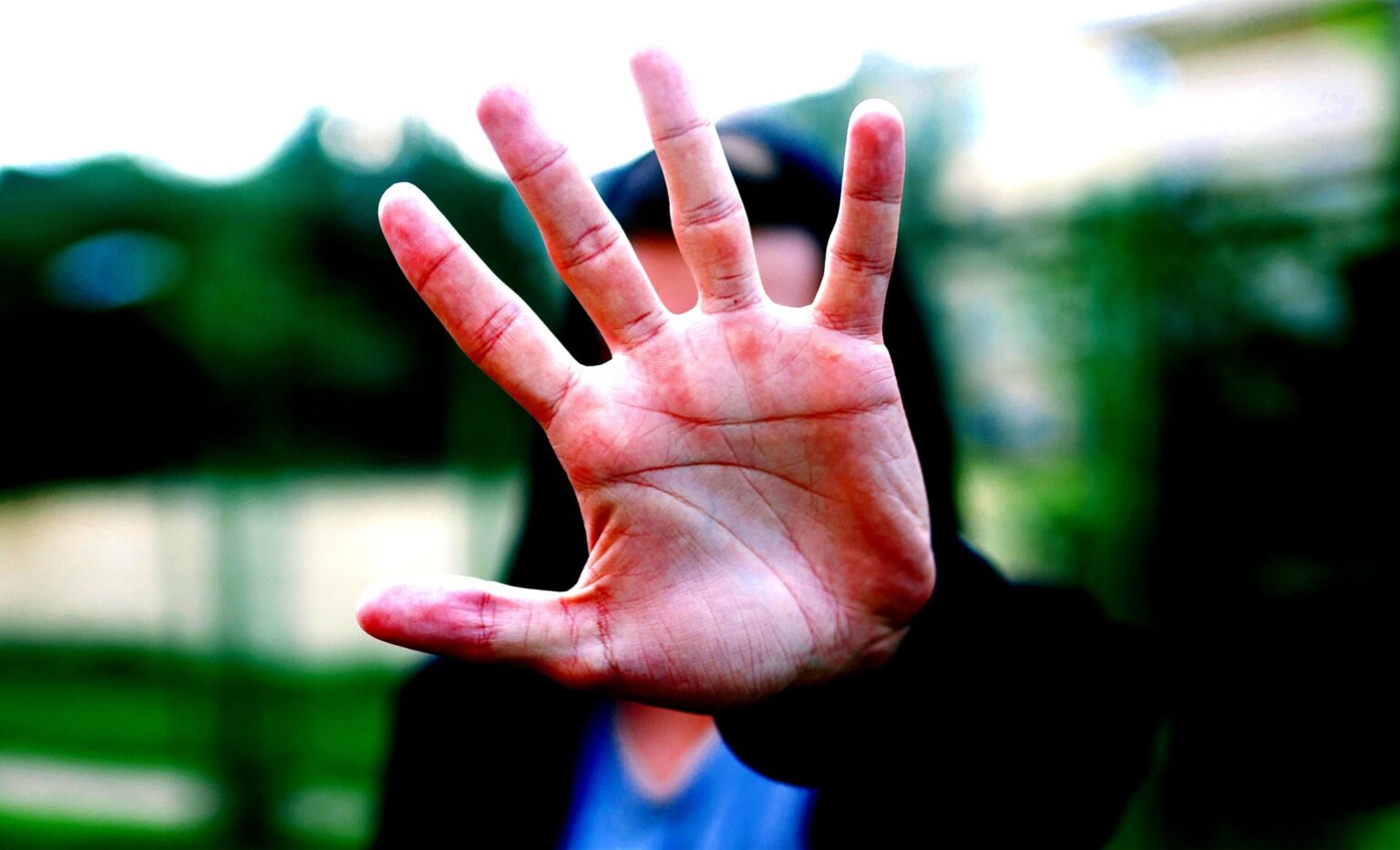 Palmar Erythema (Red Palms): Causes and Treatments