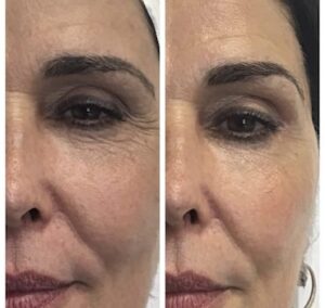 Cryotherapy Facials (Frotox): Does It Work, Side Effects, and Alternatives