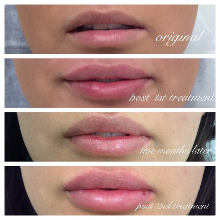 How Long Do Lip Fillers Last: Top Brands Compared, Alternatives & FAQs