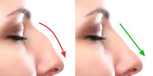 Roman Noses Versus Greek Nose - Zwivel